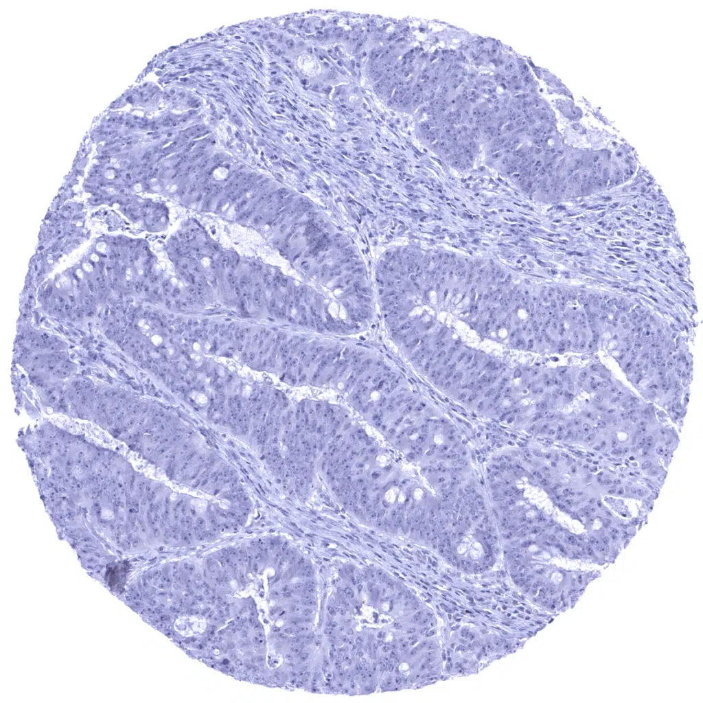 Cancer Tissue Gallery- GTX04368 | GeneTex