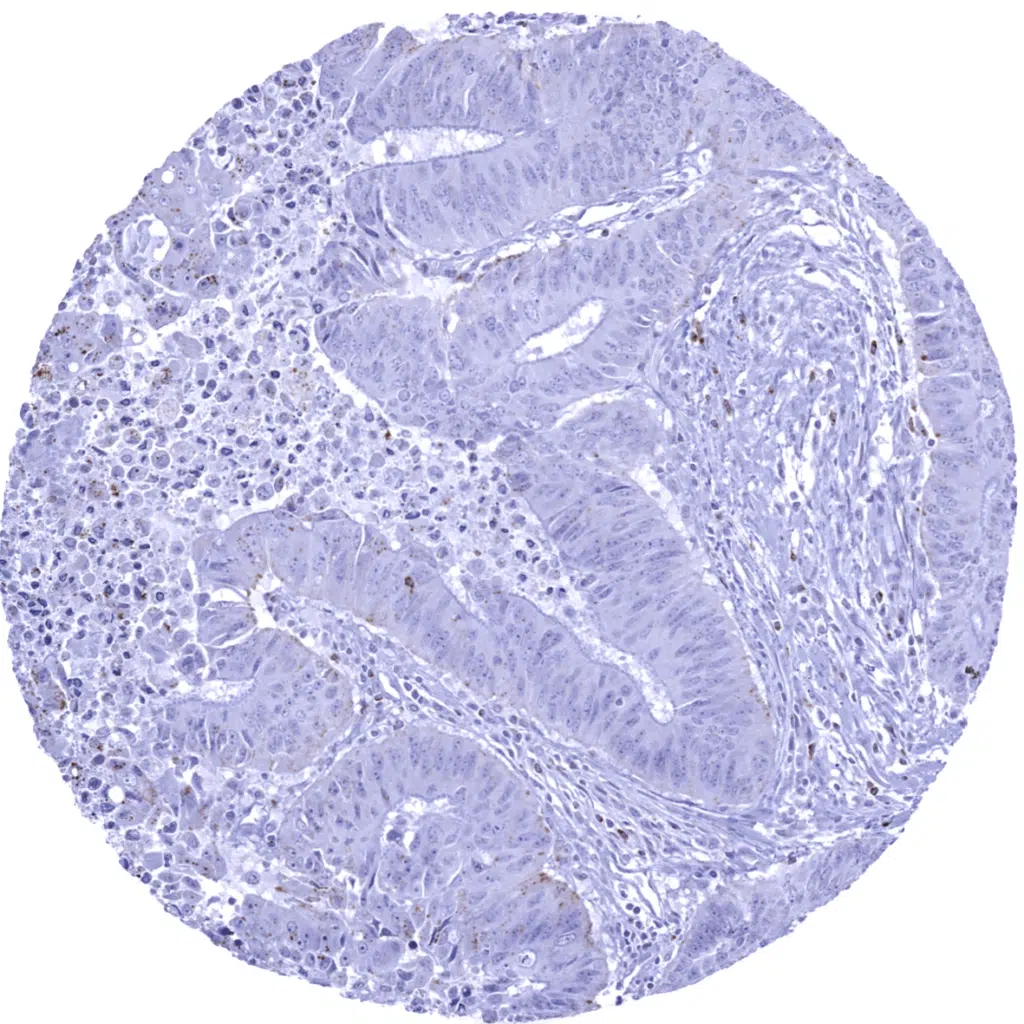 Cancer Tissue Gallery- GTX04439 | GeneTex