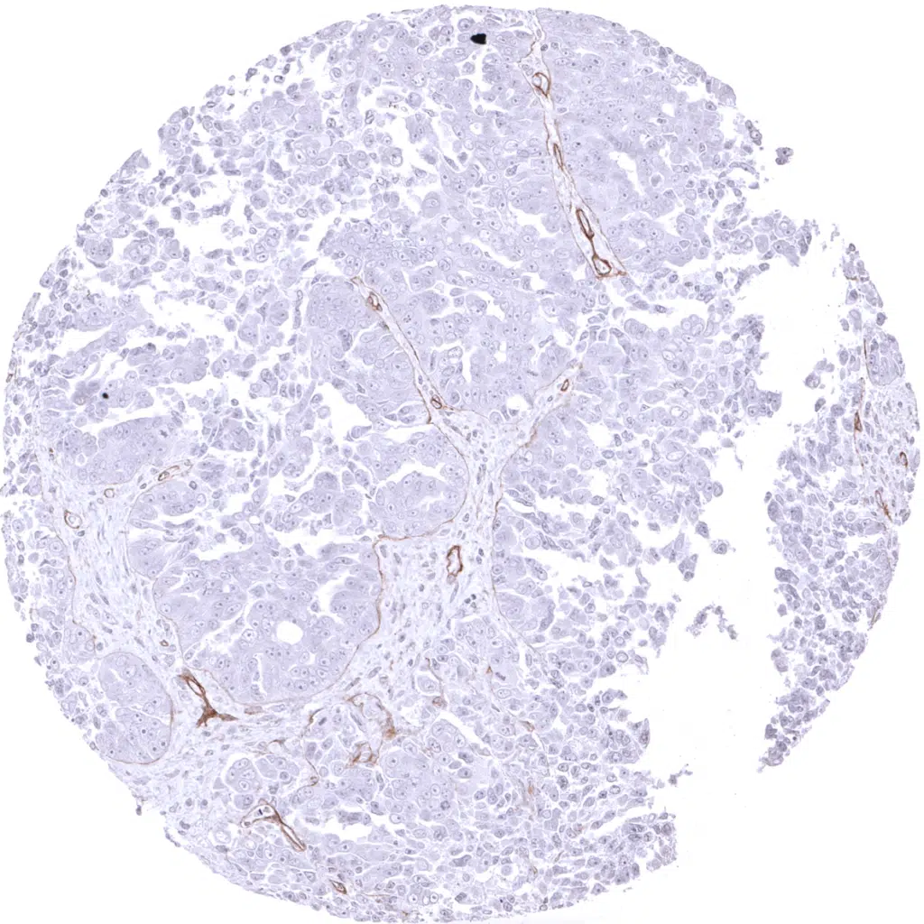 Cancer Tissue Gallery- GTX04434 | GeneTex