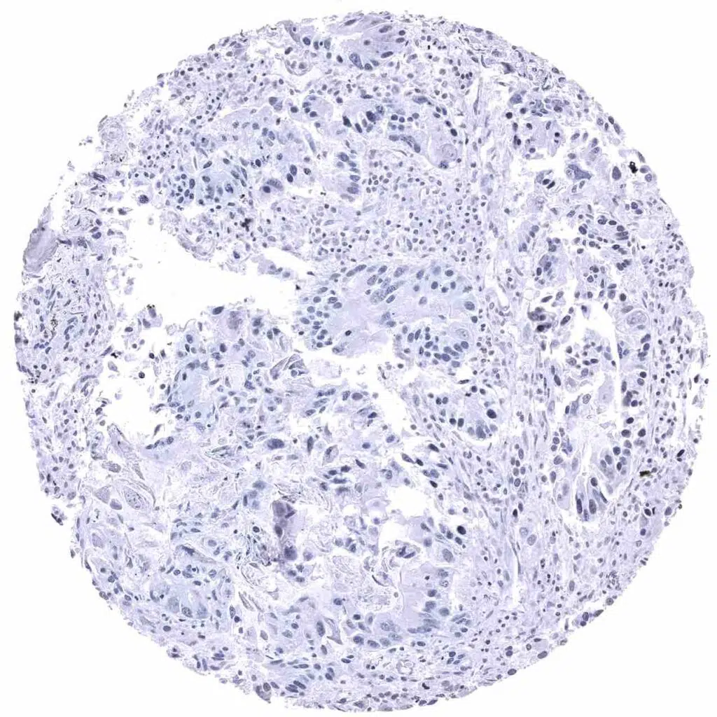 Cancer Tissue Gallery- GTX04474 | GeneTex