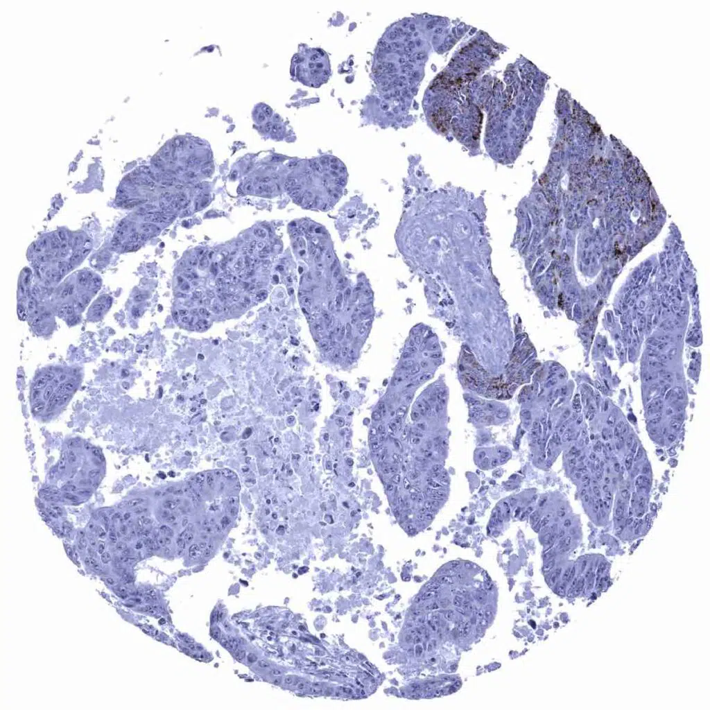 Cancer Tissue Gallery- GTX04478 | GeneTex