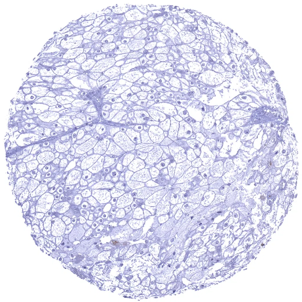 Cancer Tissue Gallery- GTX04415 | GeneTex